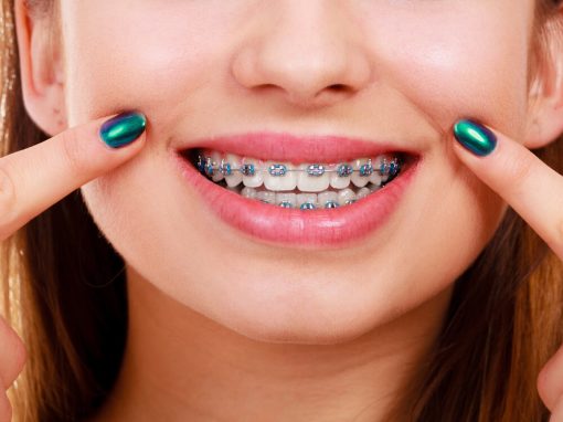 Self-Ligating Braces vs. Traditional Braces | Peterson Ortho